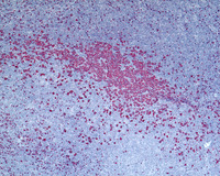 NLPHL with progression