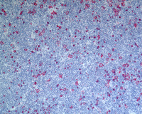 NLPHL with progression