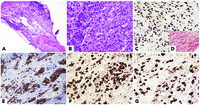 Extensive Kaposi sarcoma infiltration in bone marrow in a patient with HIV