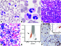Neutrophilic leukemoid reaction associated with plasma cell neoplasm mimicking chronic ...