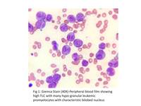 Microgranular acute promyelocytic leukemia with hyperleukocytosis and ...