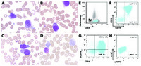 Azurophilic granular blasts are not always part of myeloid lineage: an ...