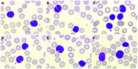 Marked lymphocytosis and atypical cells with a cleft nucleus in a 1 ...