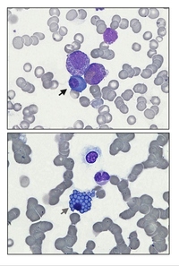 Plasma cell and Mott cell (100x)