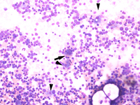 Figure b. Bone marrow aspirate smear, 100X, Giemsa stain showing blasts ...