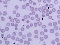 Leishman Stain 100X: Mushroom shaped cells, Blister cells and Bite cells