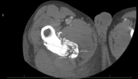 CT Rt Femur: Fig 1- Scout Image, Fig 2- cross section, Fig 3- coronal ...