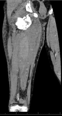 CT Rt Femur: Fig 1- Scout Image, Fig 2- cross section, Fig 3- coronal ...