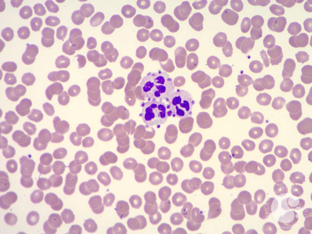 Photomicrographs from a Peripheral Blood Smear Photomicrographs from a Peripheral Blood Smear
